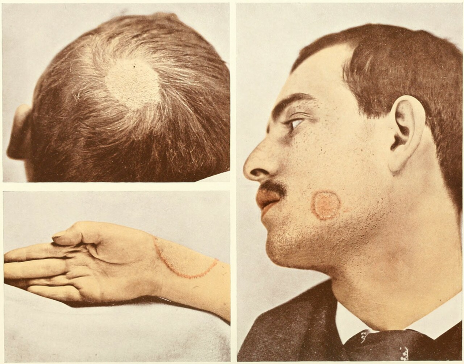 All You Need To Know About Ringworm - Durofy - Business, Technology ...